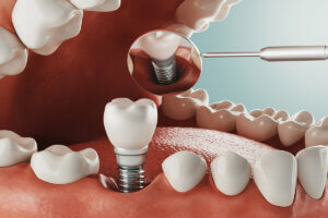 Mini Implants vs. Traditional Implants: Which Is Best? - Carmel Dental ...